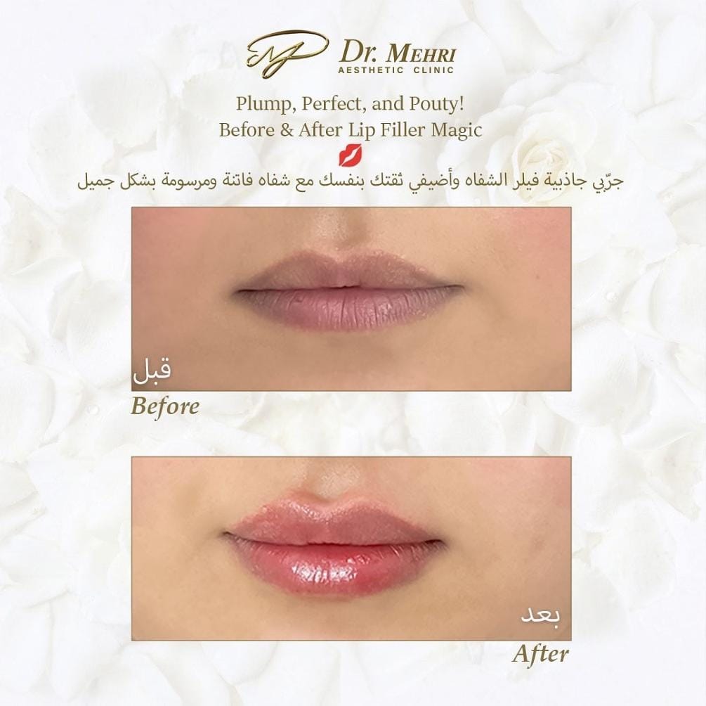 How Dubai’s Aesthetic Doctors Create the Perfect Lip Shape?